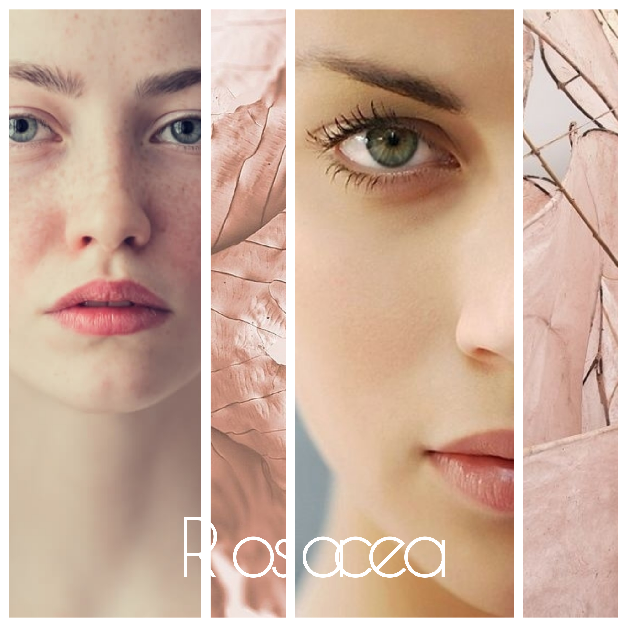 Rosácea | Madlyeklectic
